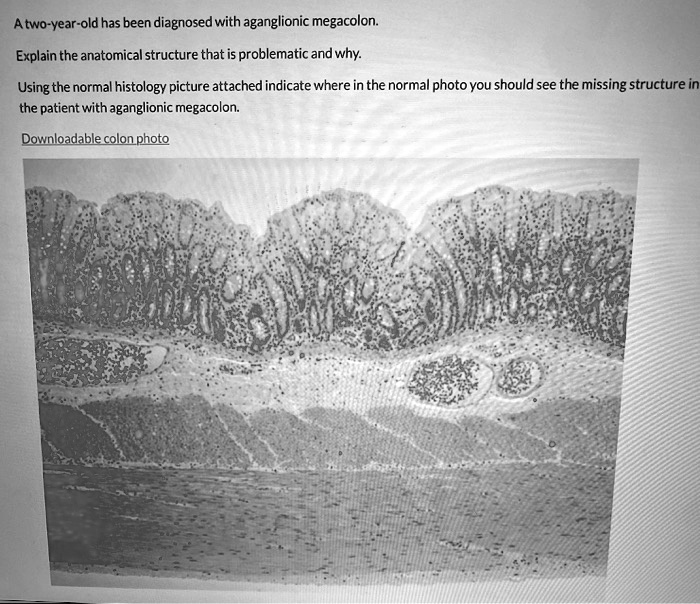 a two year old has been diagnosed with aganglionic megacolon explain ...