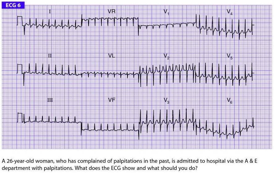 ECG 6 VR A 26-year-old woman, who has complained of palpitations in the ...