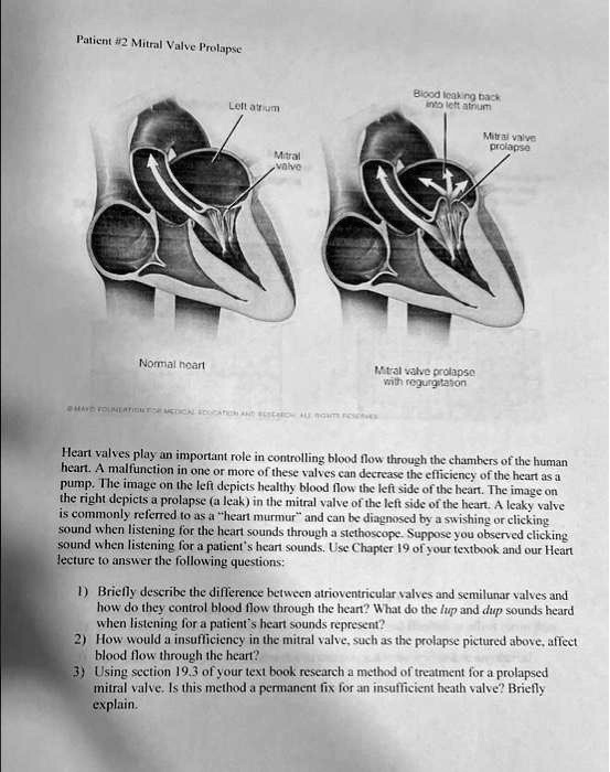 Patient #2 Mitral Valve Prolapse Left atrium Mitral valve Blood leaking ...