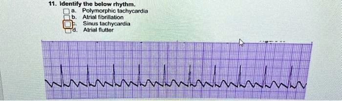 SOLVED: 11.ldentify the below rhythm. a.Polymorphic tachycardia b ...