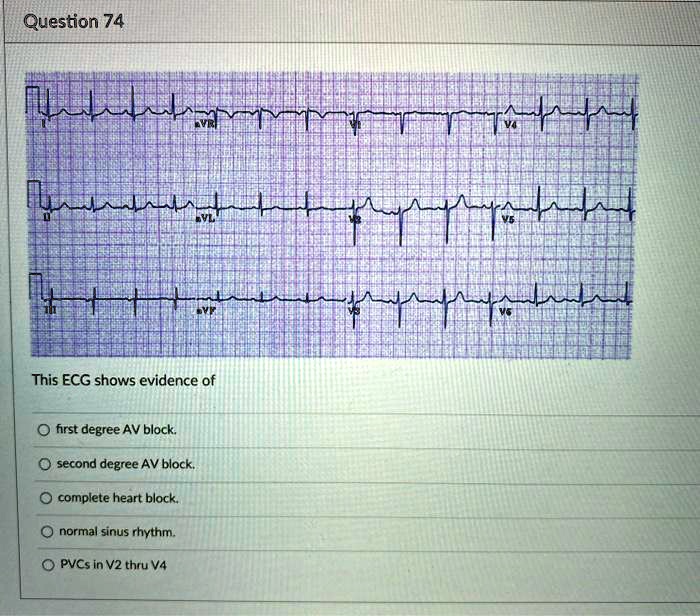 SOLVED: Question 74 This ECG shows evidence of O first degree AV block ...