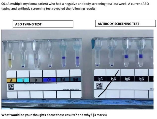SOLVED:Q1: A multiple myeloma patient who had negative antibody ...