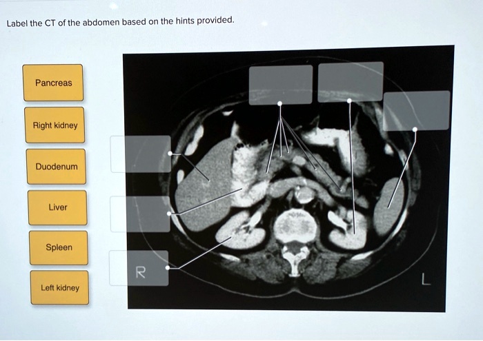 label the ct of the abdomen based on the hints provided pancreas right kidney duodenum liver ...