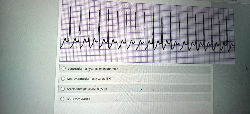 ventricular tachycardia monomorphic supraventricular tachycardia svt ...