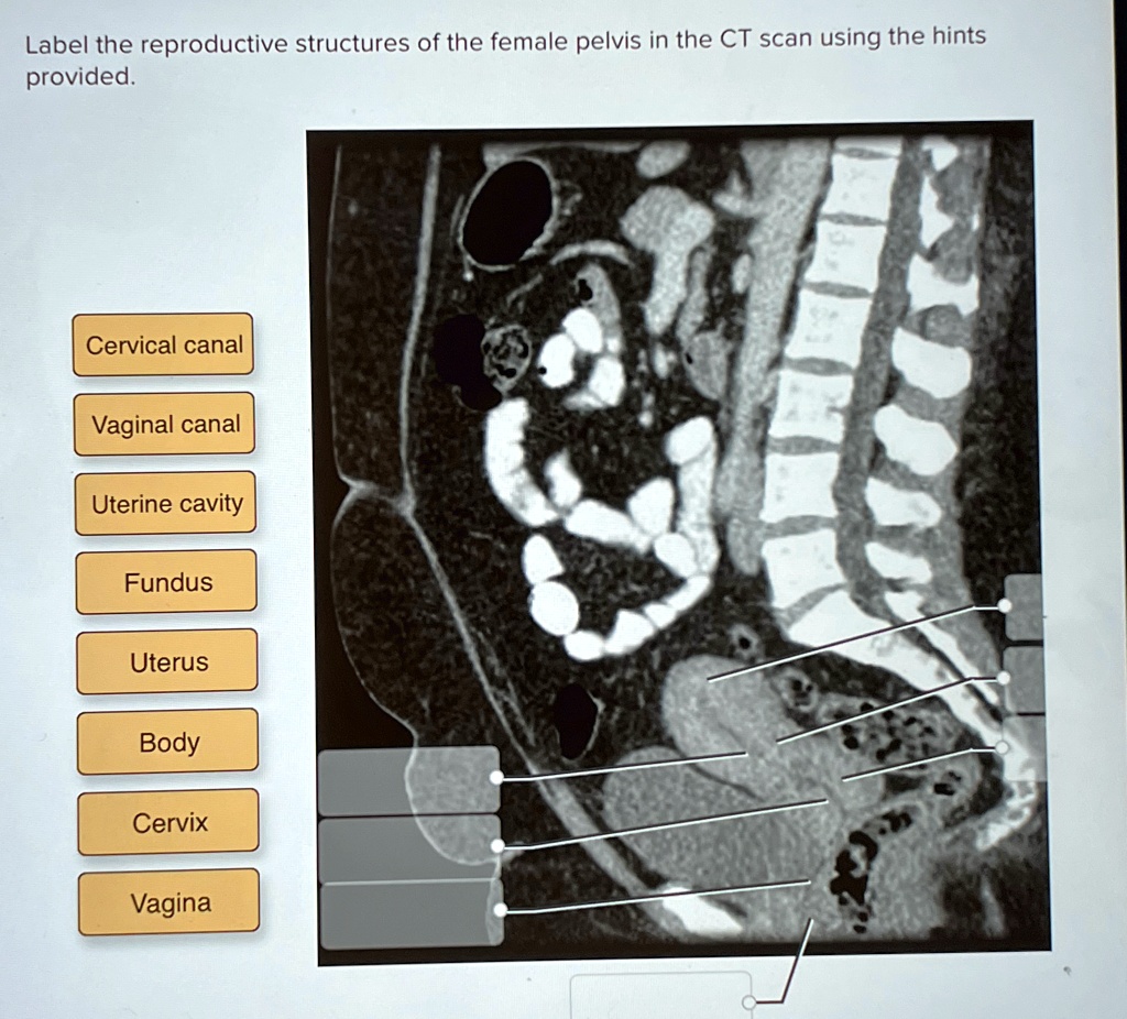 Label the reproductive structures of the female pelvis in the CT scan ...