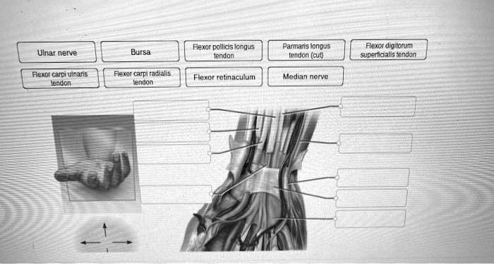 Ulnar nerve Bursa Flexor pollicis longus tendon Palmaris longus tendon ...