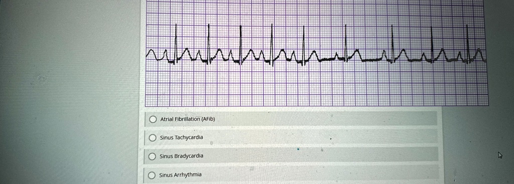 identify the rhythm atrial fibrillation afib sinus tachycardia sinus ...