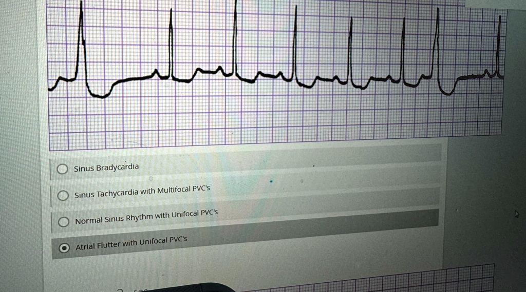 sinus bradycardia sinus tachycardia with multifocal pvcs normal sinus rhythm with unifocal pvcs ...