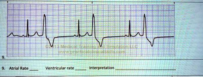 atrial rate ventricular rate interpretation 58502