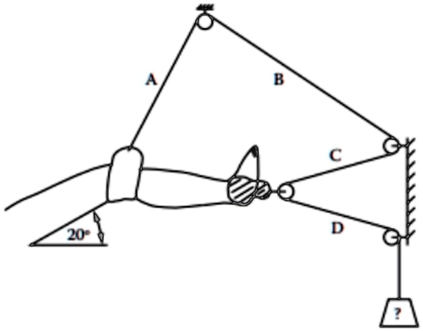SOLVED: A Russell traction (shown below) is used for immobilizing ...