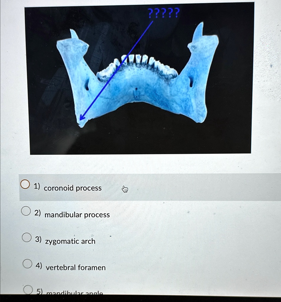 Coronoid process Mandibular process Zygomatic arch Vertebral foramen 1) Coronoid process 2 ...