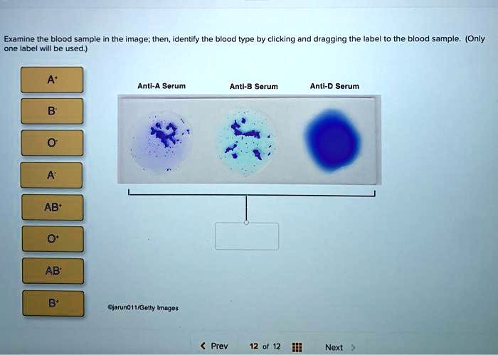 Examine the blood sample in the image; then, identify the blood type by ...