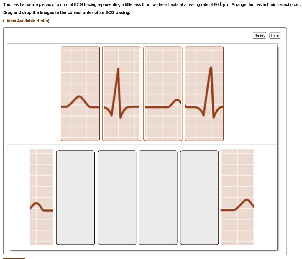 The tiles below are pieces of a normal ECG tracing representing a little less than two ...