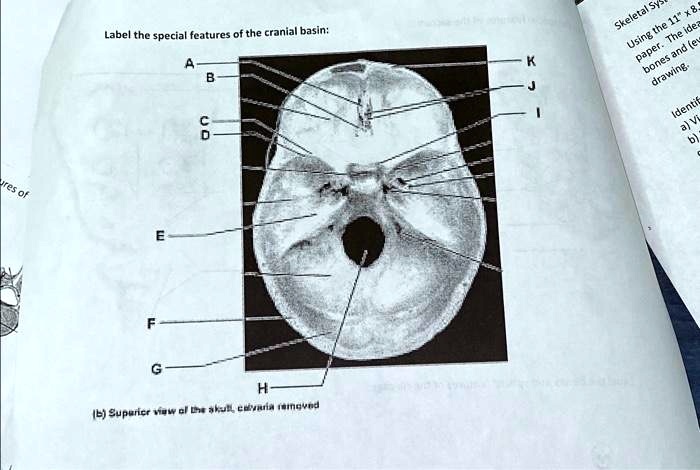Superior View Of The Skull Calvaria Removed