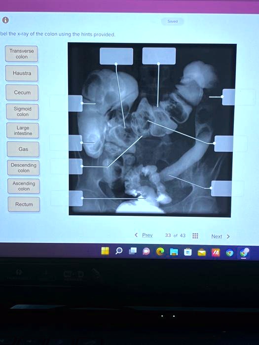 Solved Question Is Label The X Ray Of The Colon Sived Bel The X Ray Of The Colon Using The 