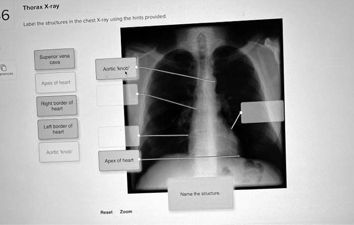 Solved Thorax X Ray 6 Label The Structures In The Chest X Ray Using
