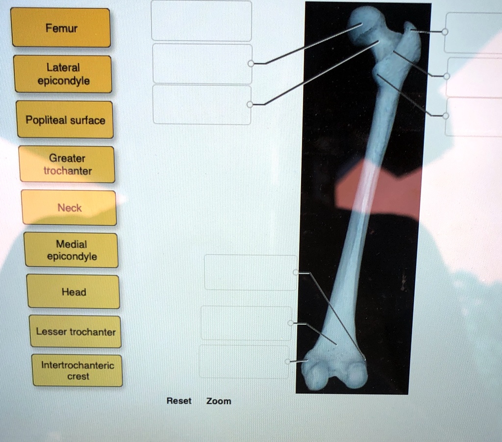 SOLVED: Label The structures of the bone Femur Lateral epicondyle ...