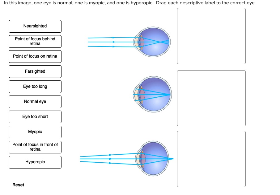 SOLVED: In this image, one eye is normal, one is myopic, and one is ...
