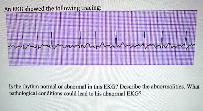 An EKG showed the following tracing: Is the rhythm normal or abnormal in this EKG? Describe the ...