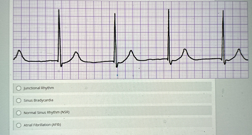 junctional rhythm sinus bradycardia normal sinus rhythm nsr atrial ...