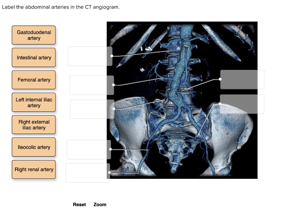 SOLVED: Label the abdominal arteries in the CT angiogram ...