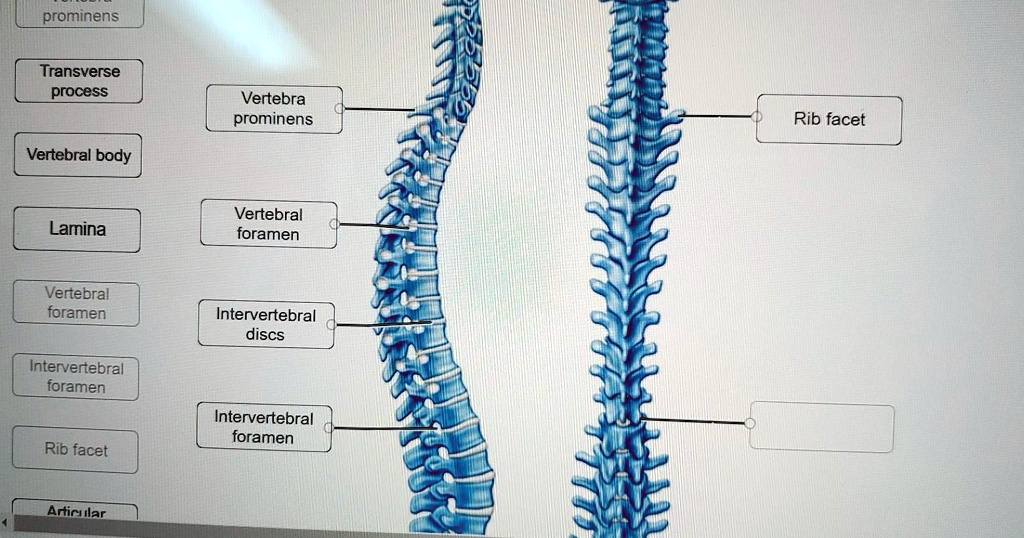 SOLVED: Prominens Transverse process Vertebra prominens Rib facet ...