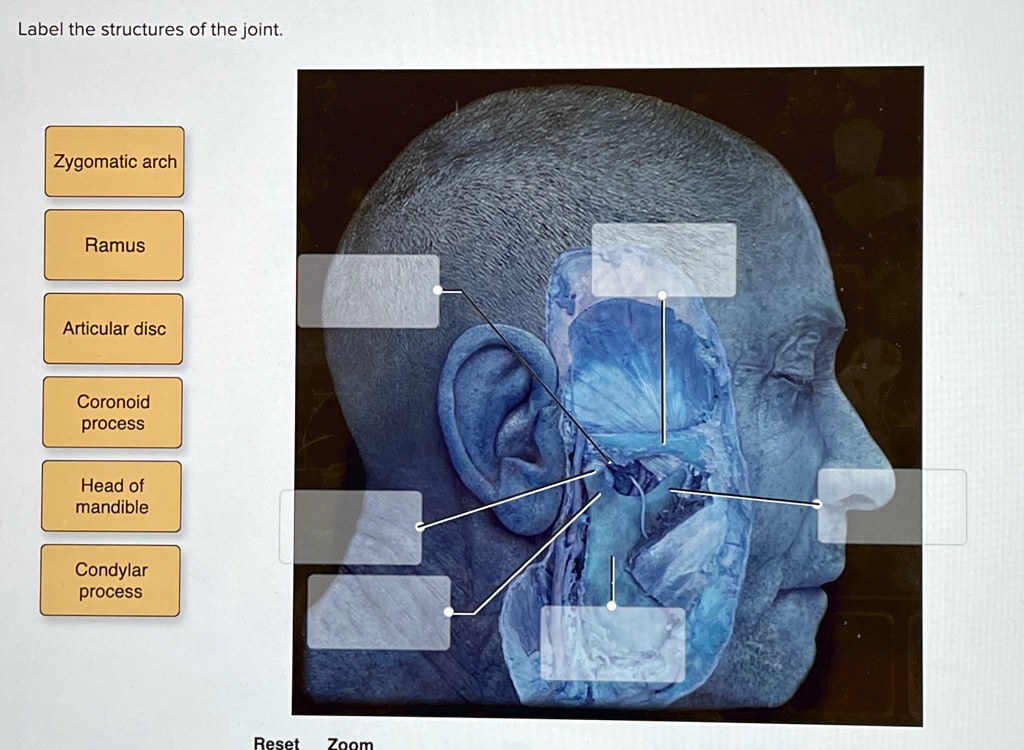 Label the structures of the joint: - Zygomatic arch - Coronoid process ...