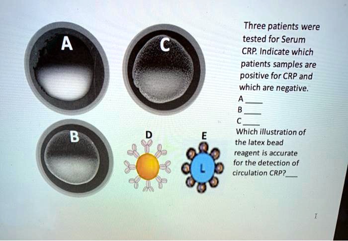 three patients were tested for serum crp indicate which patients ...