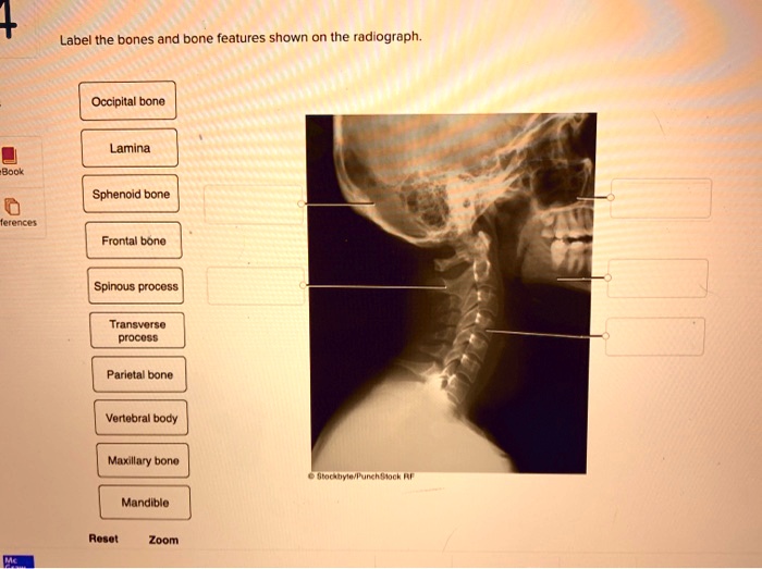 [GET ANSWER] Label the bones and bone features shown on the radiograph. Occipital bone Lamina ...