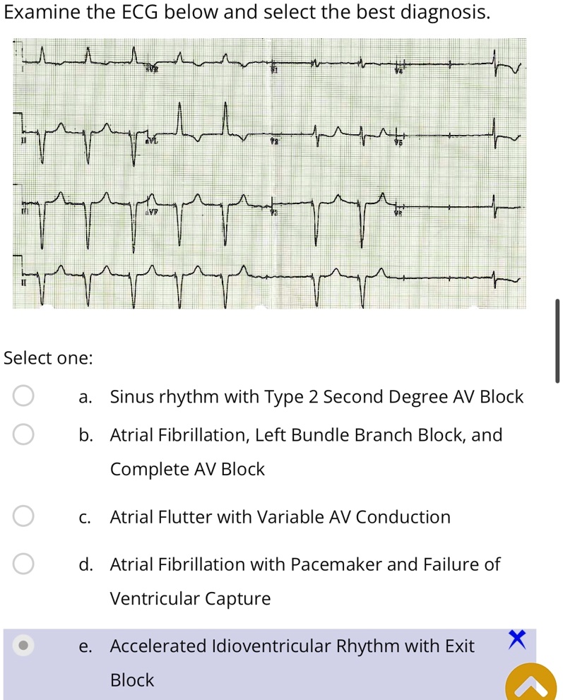 examine the ecg below and select the best diagnosis select one a sinus ...