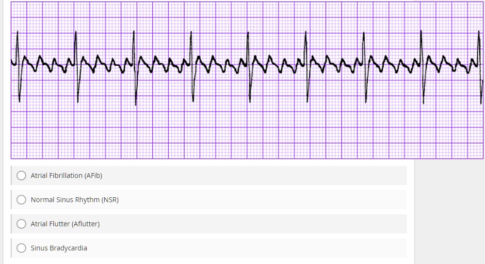 atrial fibrillation afib normal sinus rhythm nsr atrial flutter ...