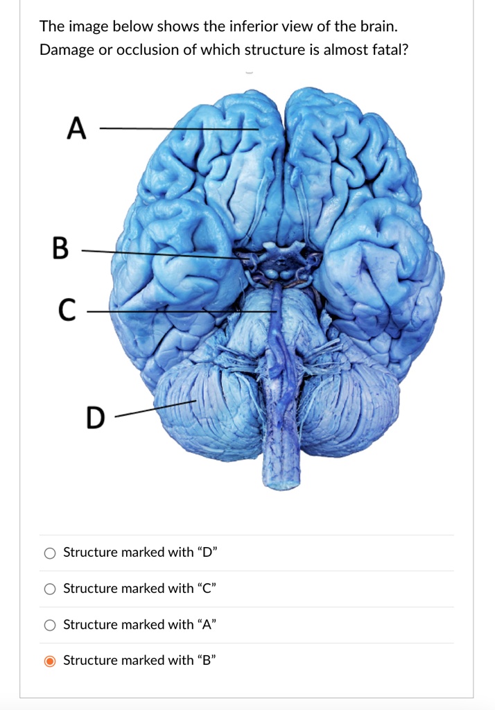 The image below shows the inferior view of the brain. Damage or ...