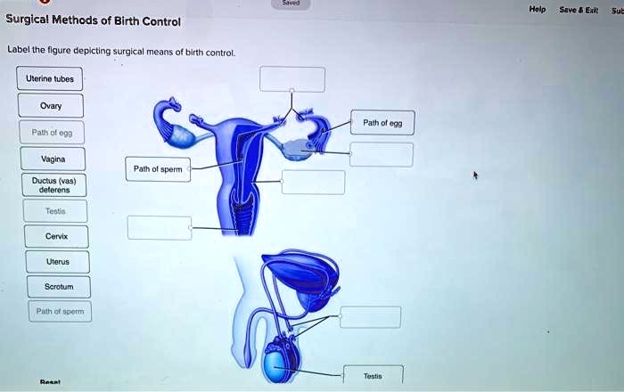 SOLVED: Pavea Surgical Methods of Birth Control Help Save Ex Sut Label ...