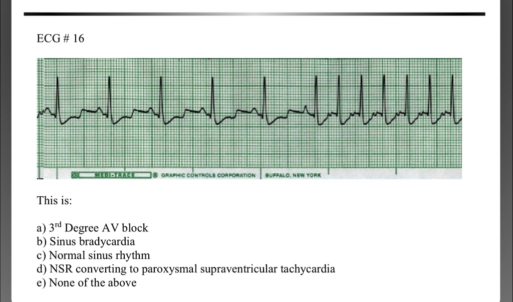 ECG # 16 This is: a) 3^(rd ) Degree AV block b) Sinus bradycardia c ...