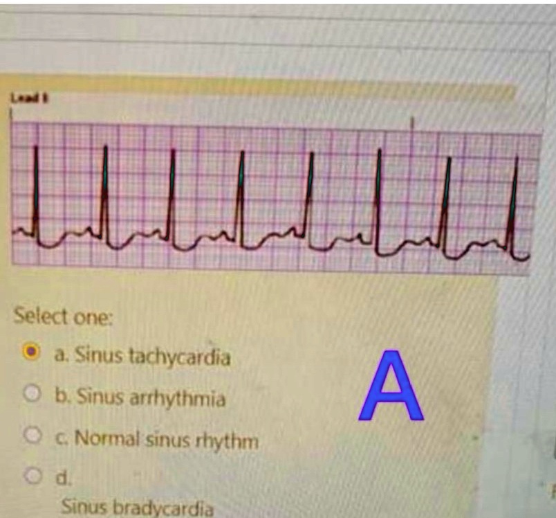 SOLVED: Load Select one: a. Sinus tachycardia b. Sinus arrhythmia c ...