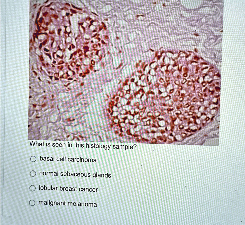 What is seen in this histology sample? basal cell carcinoma normal ...