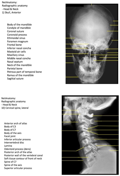NetAnatomy: Radiographic anatomy - Head Neck 1) Skull, Anterior Body of ...