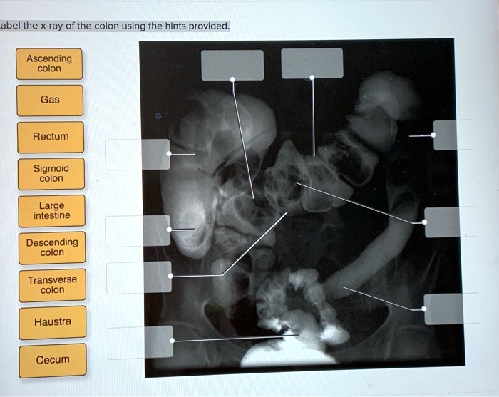 Label the x-ray of the colon using the hints provided. Ascending colon ...