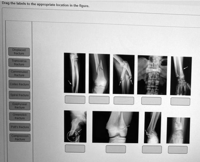 Solved Drag The Labels To The Appropriate Location In The Figure Displaced Fracture Transverse