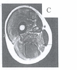 SOLVED: (b) Figure Q4.2 shows muscle biopsy sections of (A) normal ...