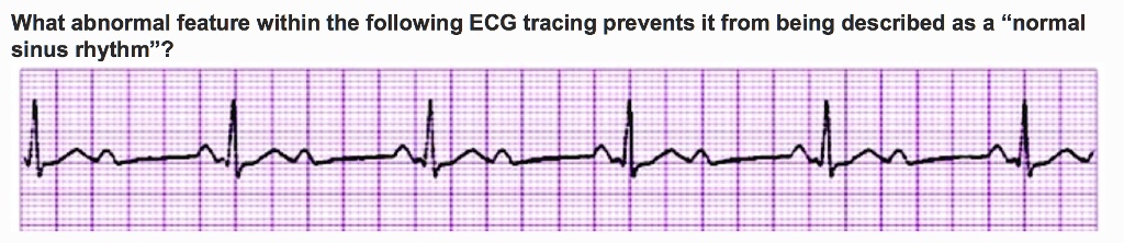 What abnormal feature within the following ECG tracing prevents it from ...