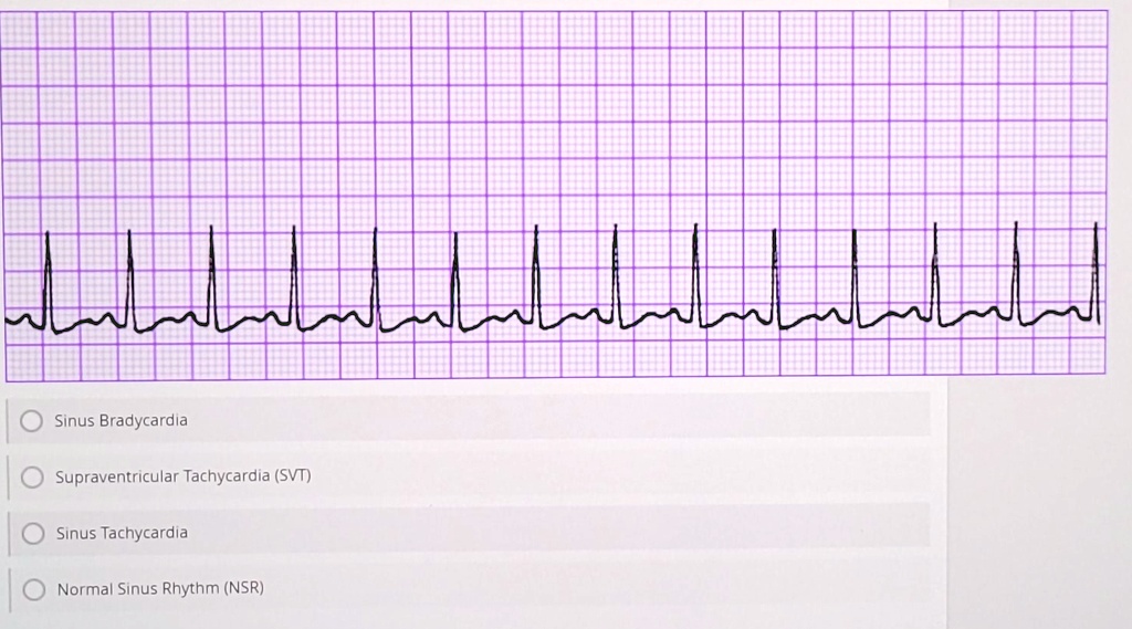 sinus bradycardia supraventricular tachycardia svt sinus tachycardia ...