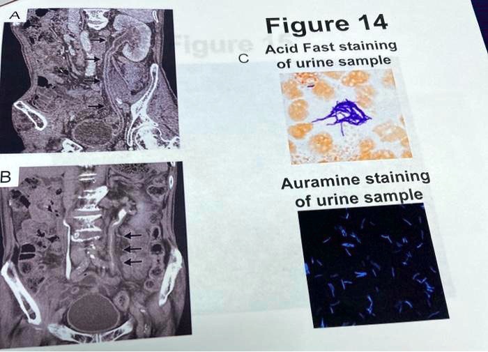 SOLVED: Figure 14 - Acid-Fast staining of urine sample Auramine ...