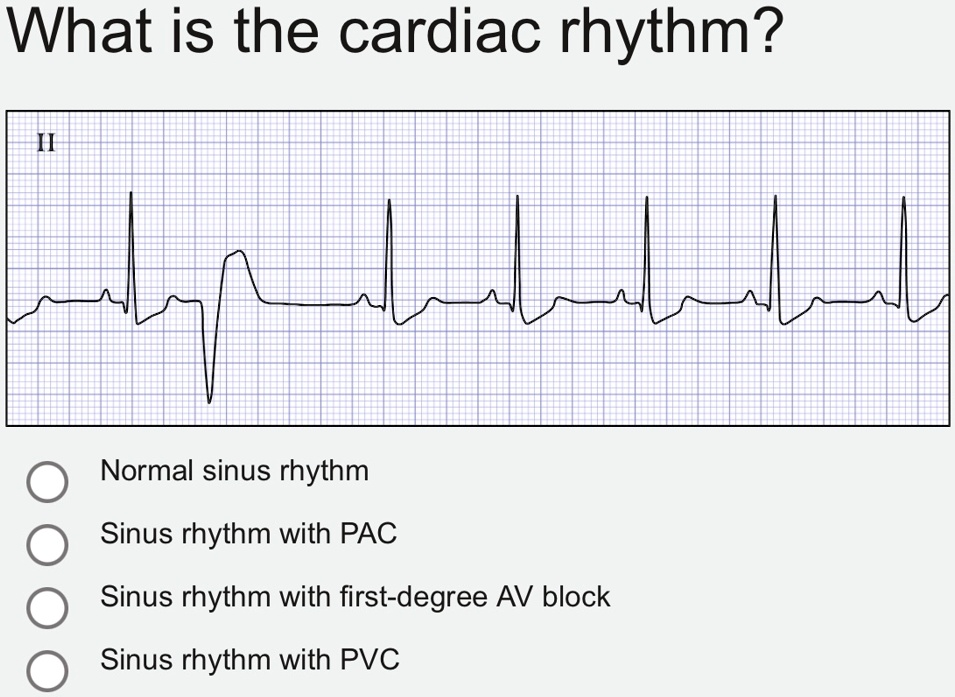 what is the cardiac rhythm shown in the ekg strip choose from multiple ...