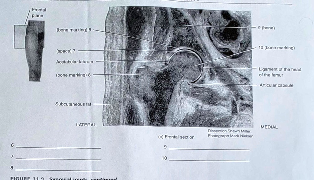 SOLVED: Frontal plane (bone marking) 9 (bone) 10 (bone marking) space ...