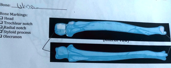Bone: Ulna Bone Markings: Head, Trochlear notch, Radial notch, Styloid ...