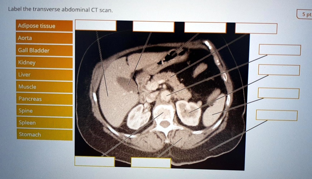 SOLVED: Label the transverse abdominal CT scan. Adipose tissue Aorta ... SOLVED: Label the transverse abdominal CT scan. Adipose tissue Aorta ...