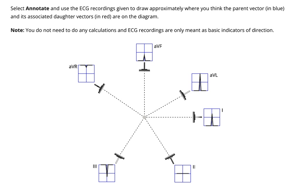 Select Annotate and use the ECG recordings given to draw approximately where you think the ...