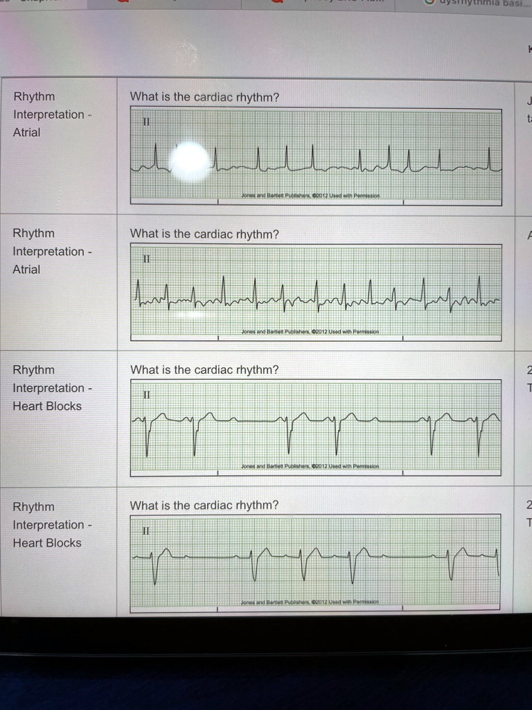 what is the cardiac rhythm on each rhythm strip tytnmia dasi rhythm ...