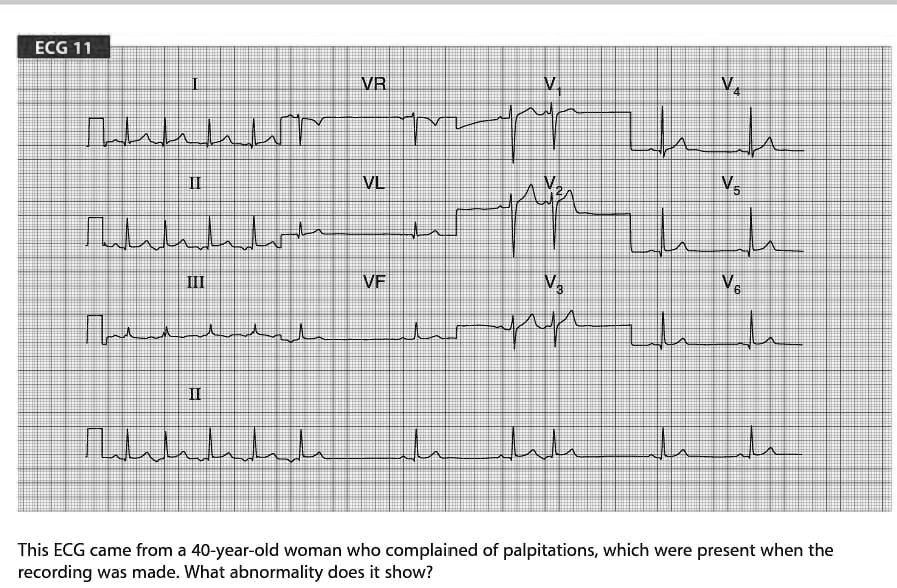 I VR V1 V4 II VL V2 V5 III VF V3 V6 II This ECG came from a...